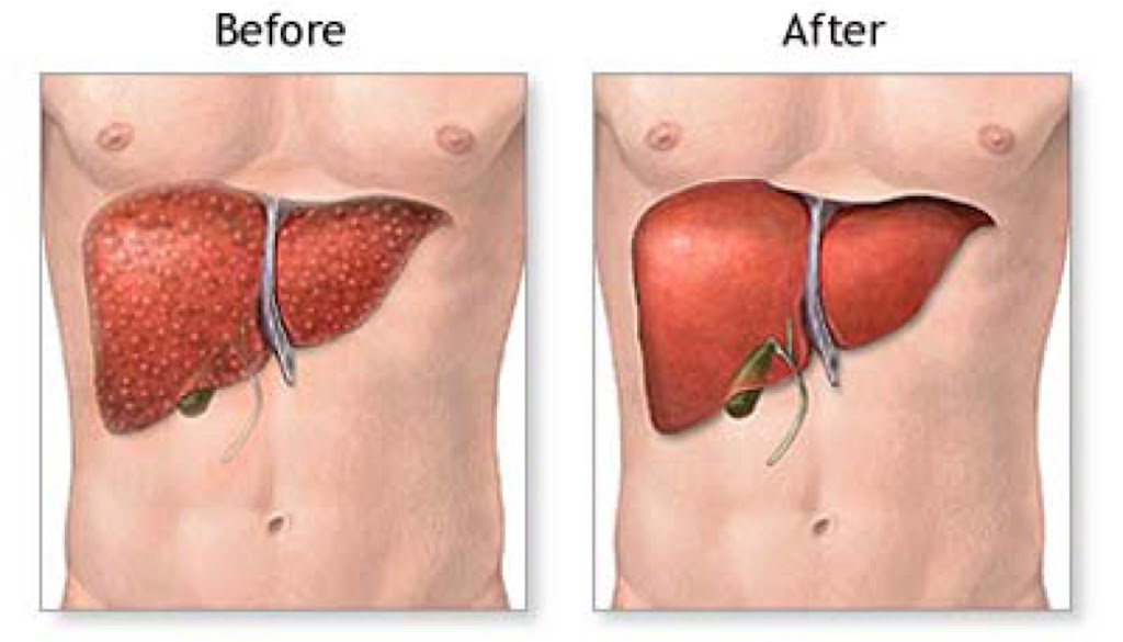 What Is Liver Transplantation Dr Divakar Jain what-is-liver-transplantation-dr-divakar-jain